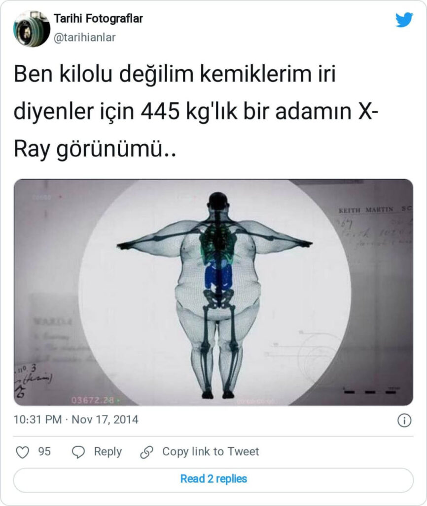 Kilolu İnsan Röntgenine Ait Sanılan Görsel - Malumatfuruş